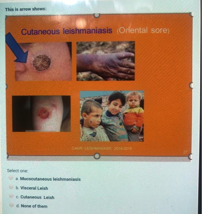 Solved This is arrow shows: Cutaneous leishmaniasis | Chegg.com