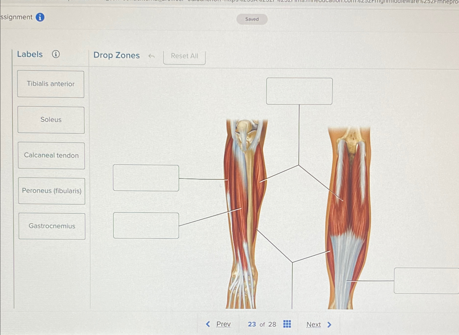 Solved ssignment (i)Labels(i)Drop ZonesTibialis | Chegg.com