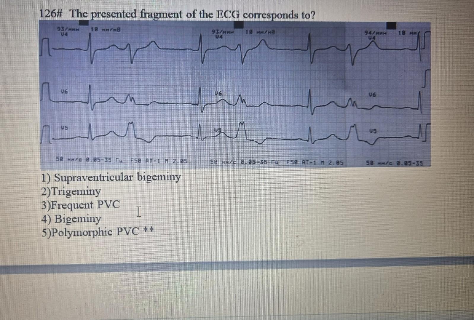 Solved 126\# The presented fragment of the ECG corresponds | Chegg.com