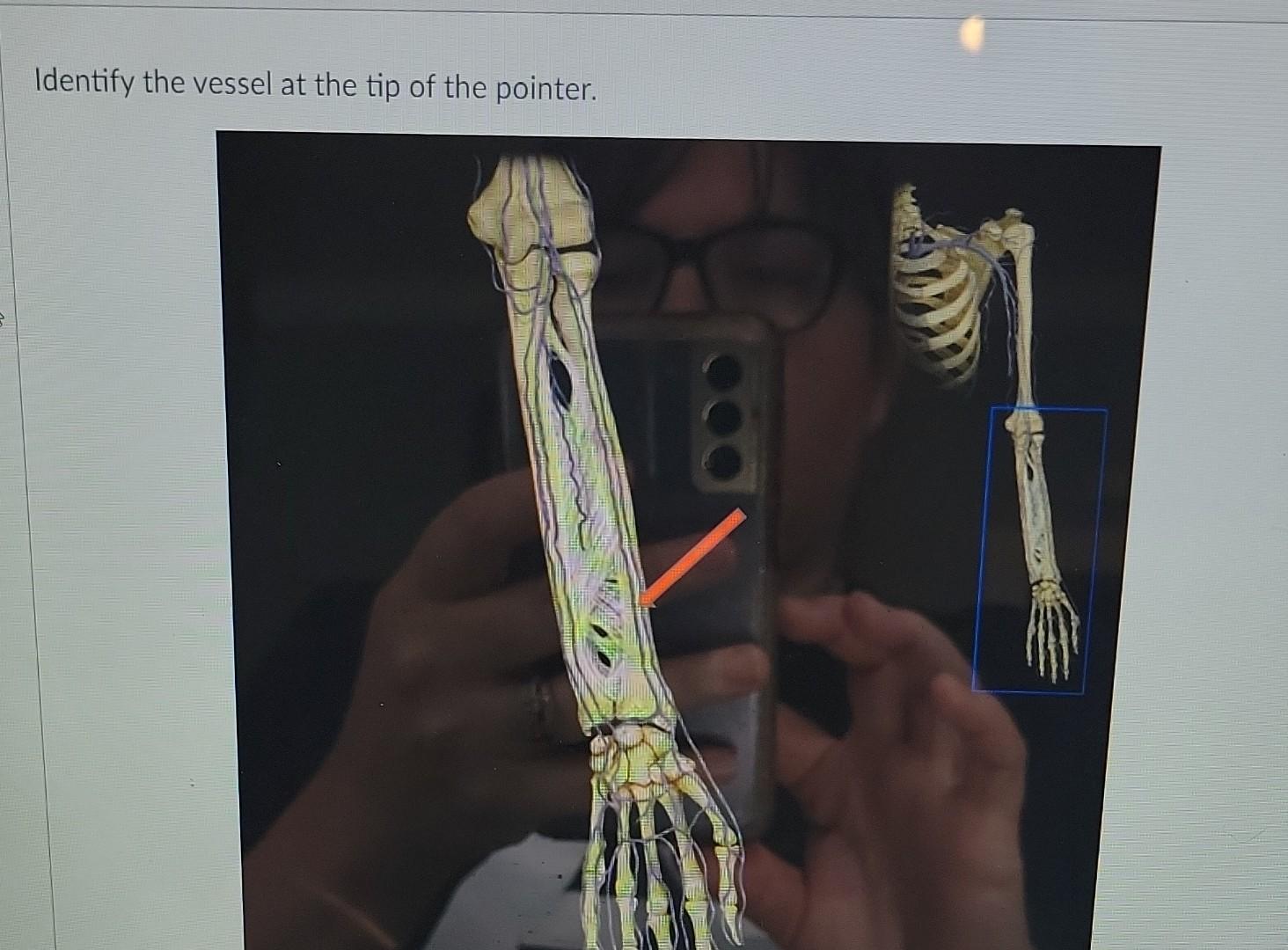 Solved Identify the vessel at the tip of the | Chegg.com