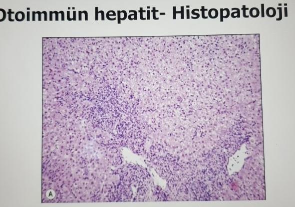 Solved this is a slide of autoimmune hepatitis | Chegg.com