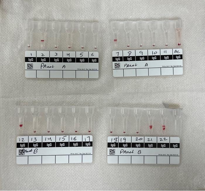 identify the red cell antigens after rolling out ? | Chegg.com