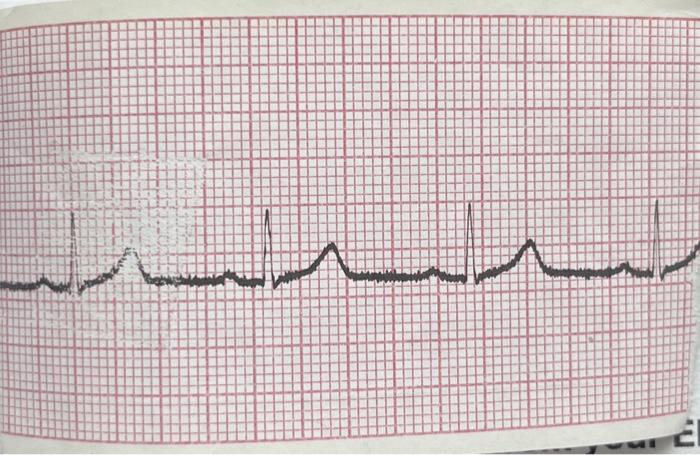 Solved EKG Data Table: Fill in with the data from your EKG. | Chegg.com