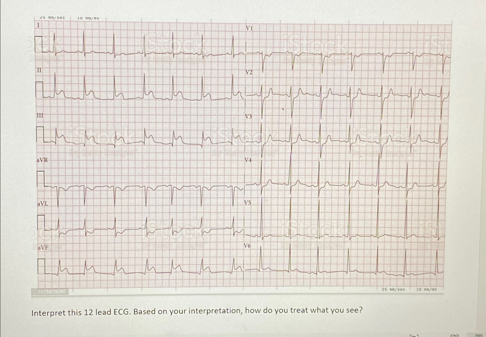 Solved Interpret this 12 ﻿lead ECG. Based on your | Chegg.com