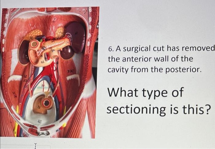 Solved 6. A surgical cut has removed the anterior wall of | Chegg.com