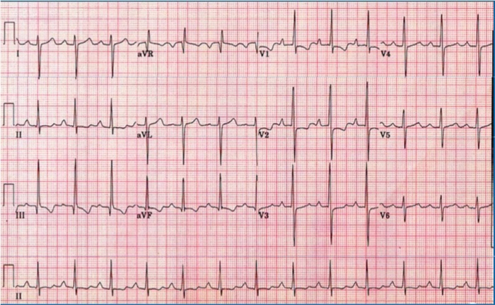 Solved CASE 1: ECG Case Presentation A 44 year-old woman | Chegg.com