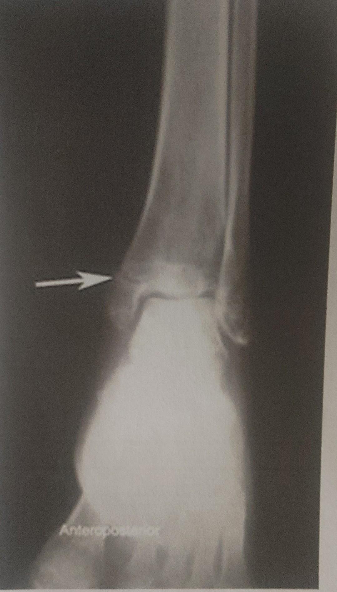 Solved fracture type and bone location type of the | Chegg.com
