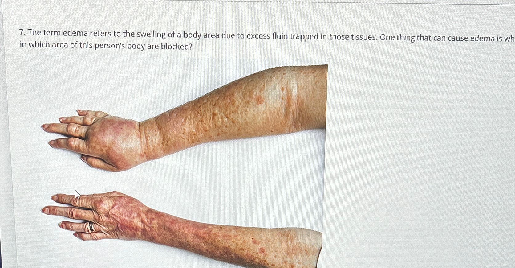 The term edema refers to the swelling of a body area | Chegg.com