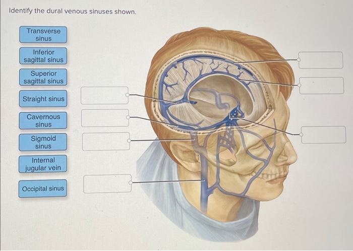 Sigmoid Sinus