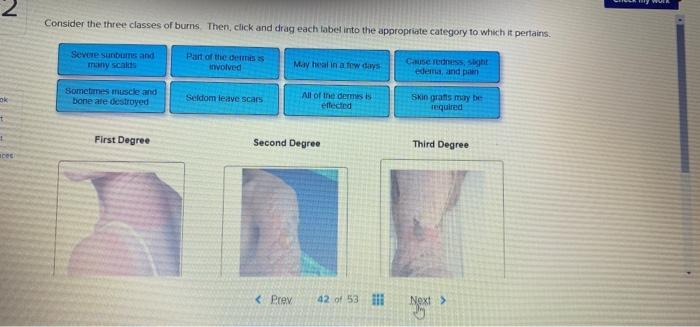 Solved w Consider the three classes of burns. Then, click | Chegg.com
