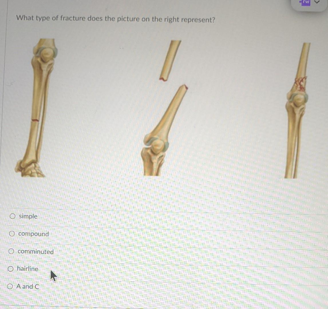 Solved What type of fracture does the picture on the right | Chegg.com