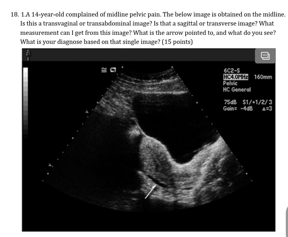 Solved 18. 1.A 14-year-old complained of midline pelvic | Chegg.com