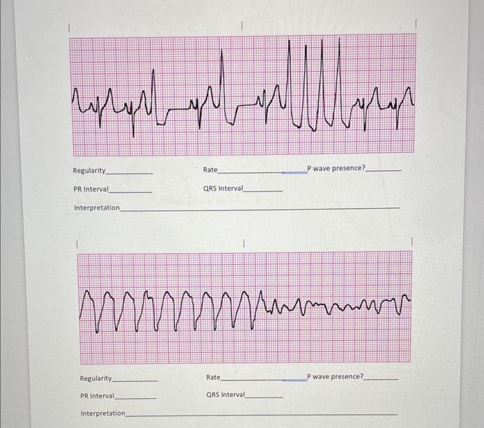 Solved Regularity Rate P wave presence? PR Interval QRS | Chegg.com