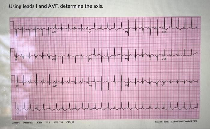 Solved Using leads I and AVF, determine the axis. RAD LAD | Chegg.com
