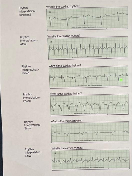 Solved Subject Rhythm Interpretation- Atrial Question | Chegg.com