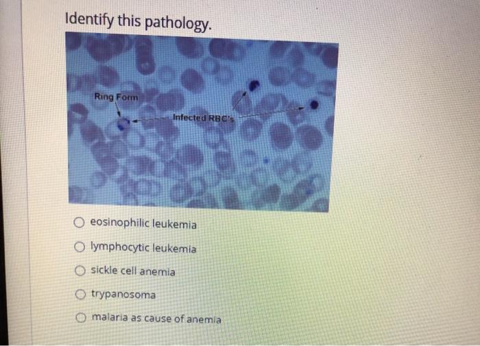 Solved Identify this pathology. Ring Form Infected RBC'S o | Chegg.com