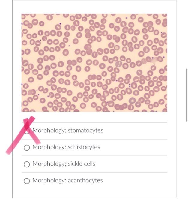 Solved Morphology: stomatocytes Morphology: schistocytes | Chegg.com