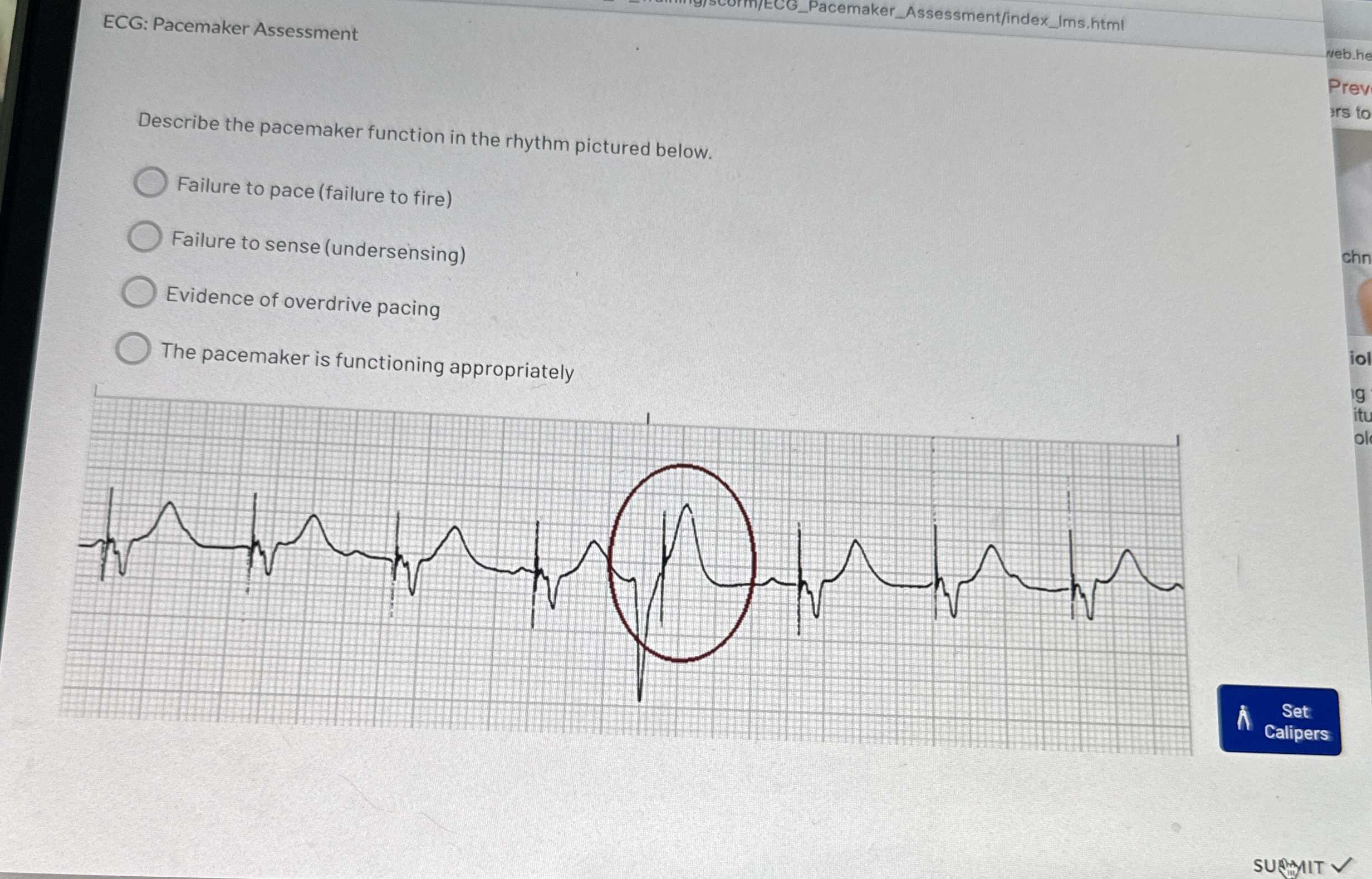 Solved ECG: Pacemaker | Chegg.com