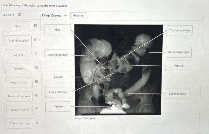 Solved Label the x-ray of the colon using the hints | Chegg.com