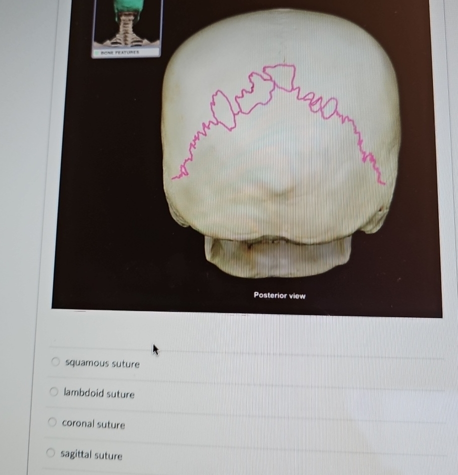 Solved ﻿squamous suturelambdoid suturecoronal | Chegg.com