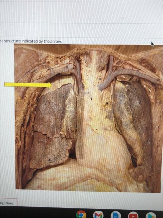 Solved what is this? I tried right lung and apex and they | Chegg.com