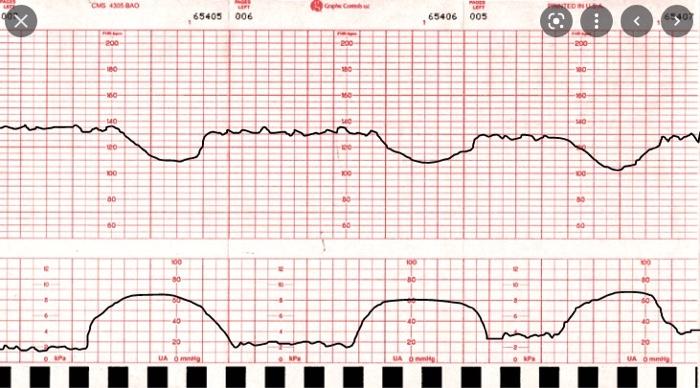Solved Find the Baseline FHR, Variability. Accelelerations | Chegg.com