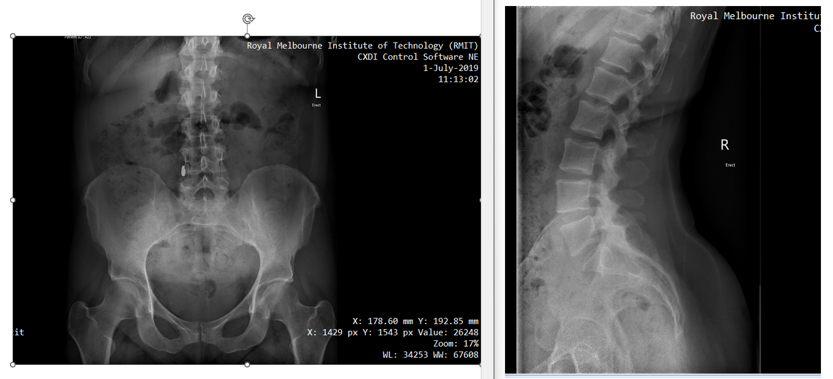 AP Pelvis Lat lumbo pelvicThis case is - 60 ﻿yo | Chegg.com
