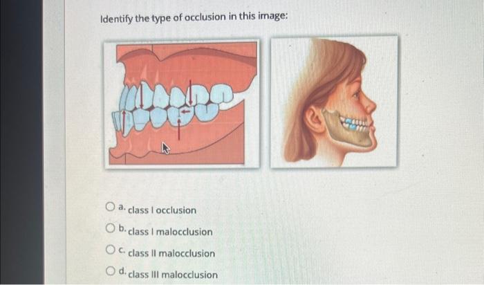 Solved Identify the type of occlusion in this image: a. | Chegg.com