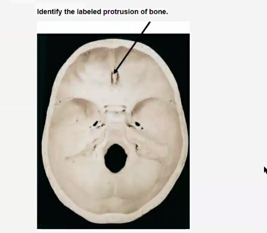 Solved Identify the labeled protrusion of bone. | Chegg.com