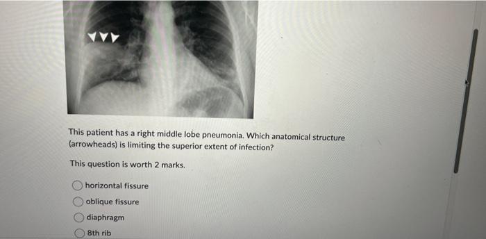 Solved This Patient Has A Right Middle Lobe Pneumonia Which