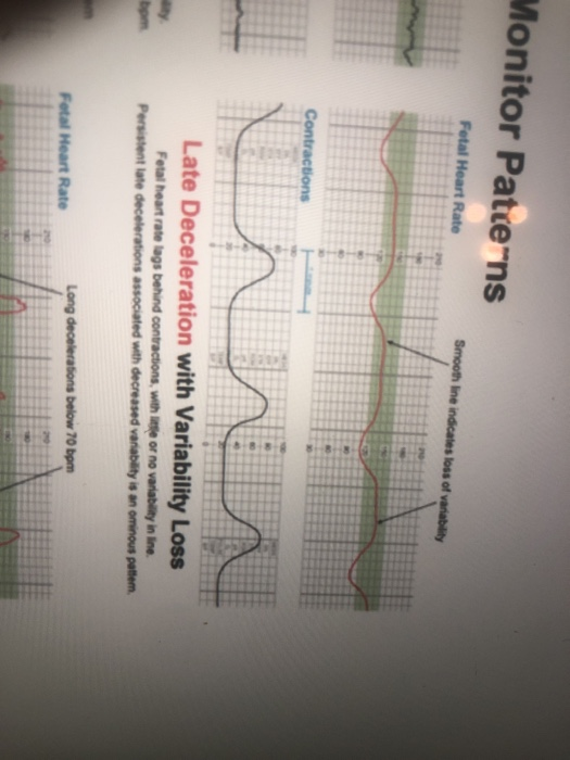 Solved Fetal Monitor Patterns Near Cocos Reassuring Pattern | Chegg.com