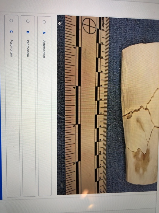 Solved Describe the timing of this long bone fracture. [39] | Chegg.com