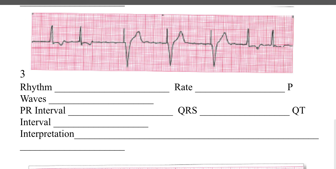 Solved Rythm?Rate? P waves?PR interval?QRS interval?QR | Chegg.com