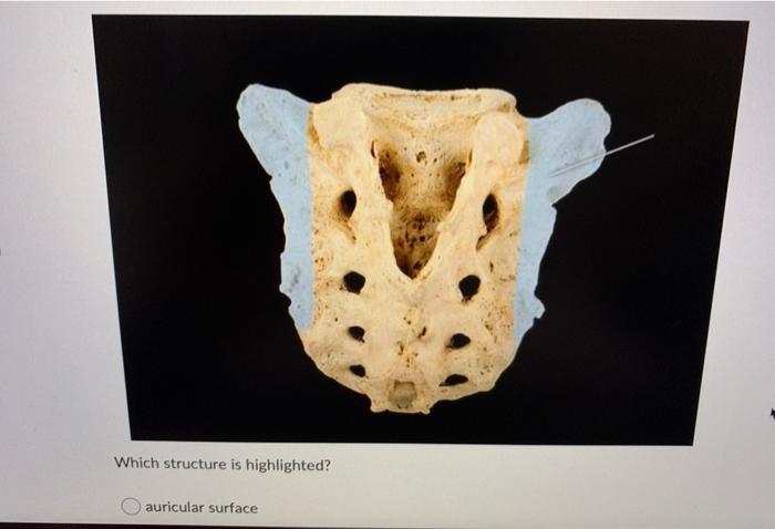 Solved Which structure of the scapula is highlighted? spine | Chegg.com