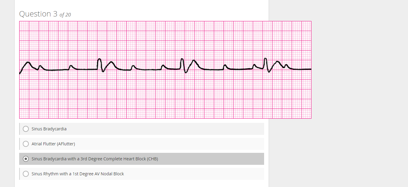 Solved Question 3 ﻿of 20Sinus BradycardiaAtrial Flutter | Chegg.com