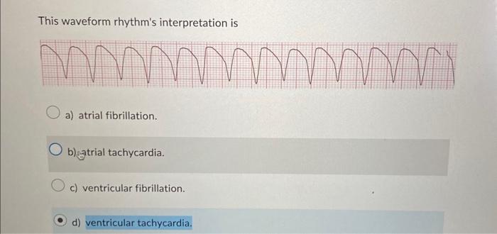 Solved This waveform rhythm's interpretation is MW www O a) | Chegg.com