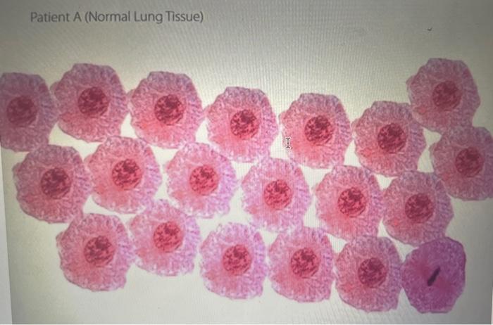 Solved Patient C (Normal Breast Tissue) Patient A | Chegg.com