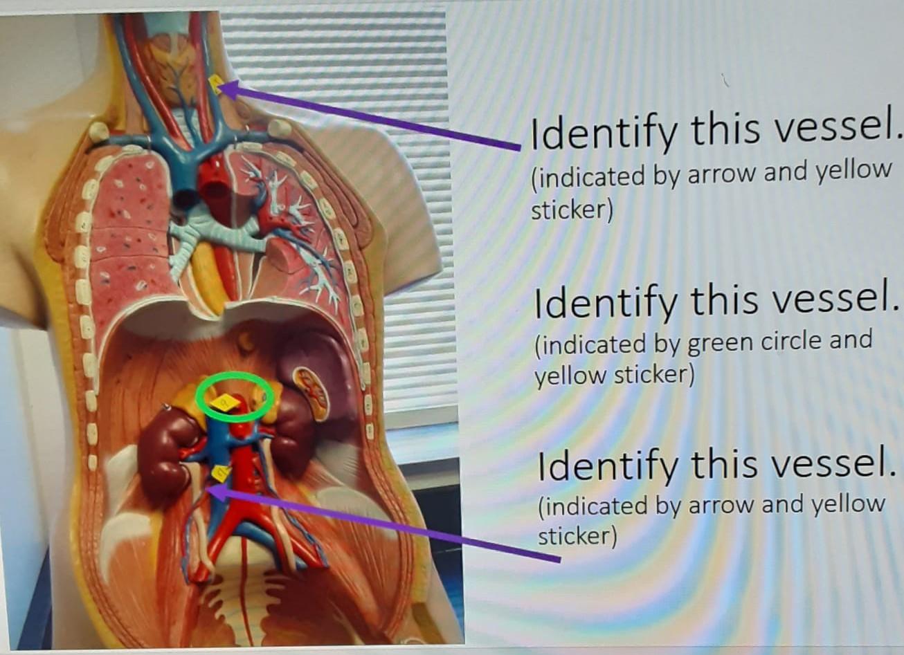 Solved Identify this vessel. (indicated by arrow and yellow | Chegg.com