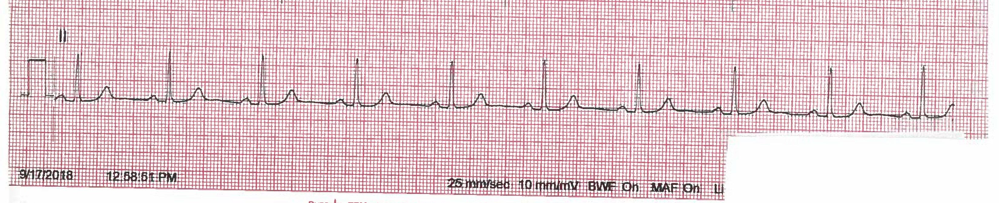 Solved Is the rhythm regular or irregular? Determine the | Chegg.com