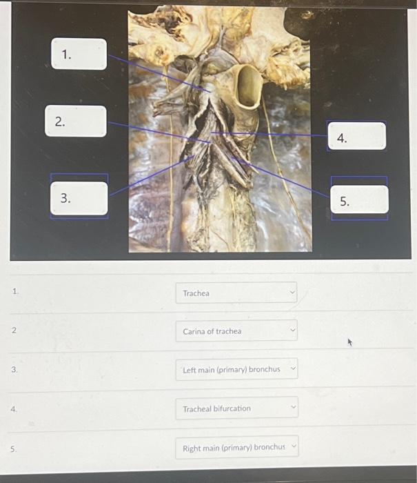 1. 2. 3. 1. Trachea 4. 5. 2 Carina of trachea 3. Left | Chegg.com