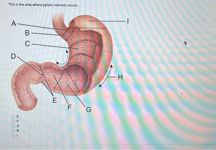 Solved This is the area where pyloric stenosis occurs. | Chegg.com