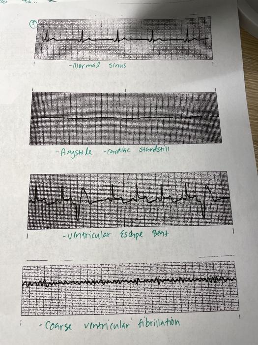 Solved - Normal sinus -Asystole -cardiac standstill | Chegg.com