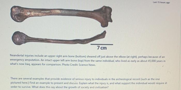 Solved Last 15 hours ago 7 cm Neandertal injuries include an | Chegg.com