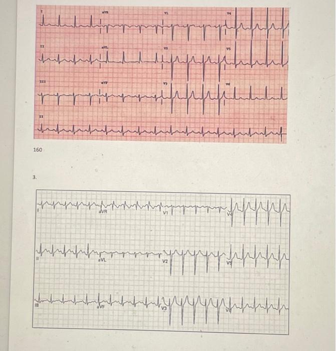 Identify for each: Step 1-Rhythm Step 2 -Rate Step | Chegg.com