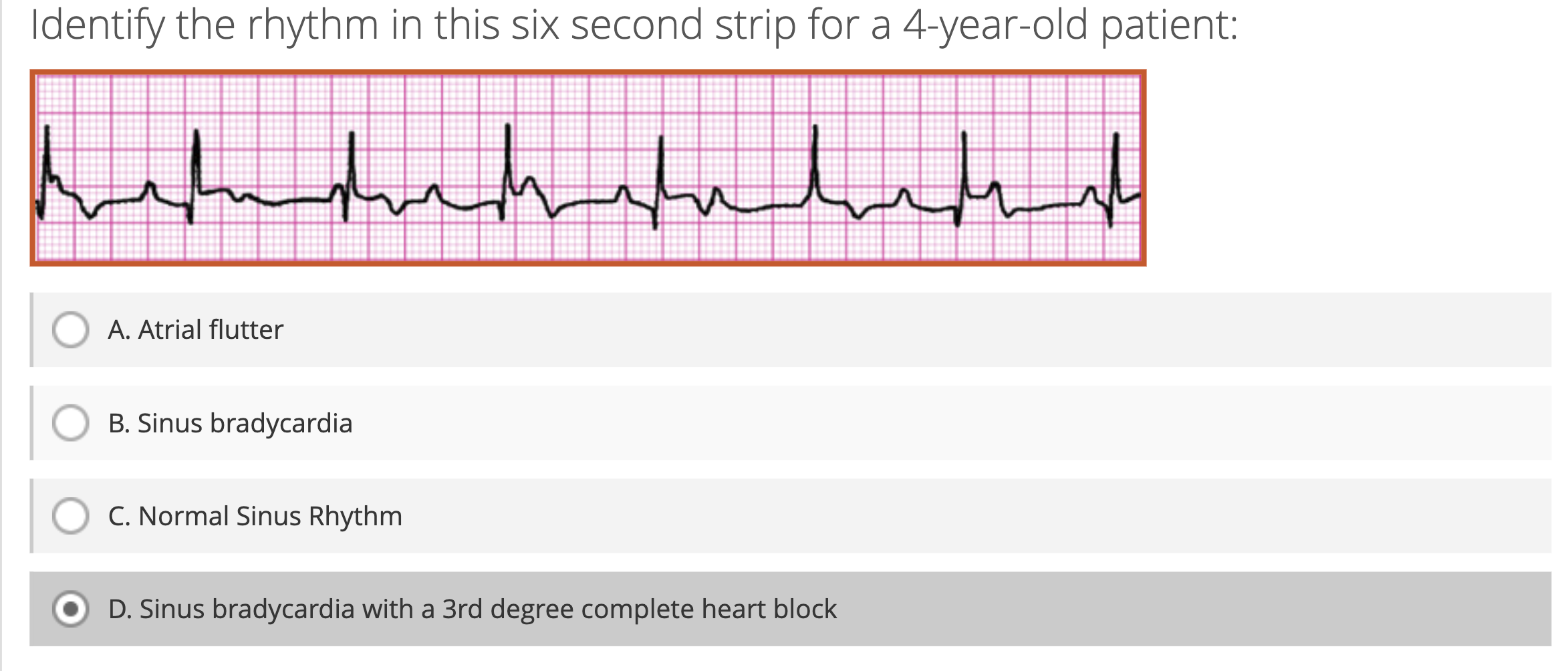 Solved Identify the rhythm in this six second strip for a | Chegg.com