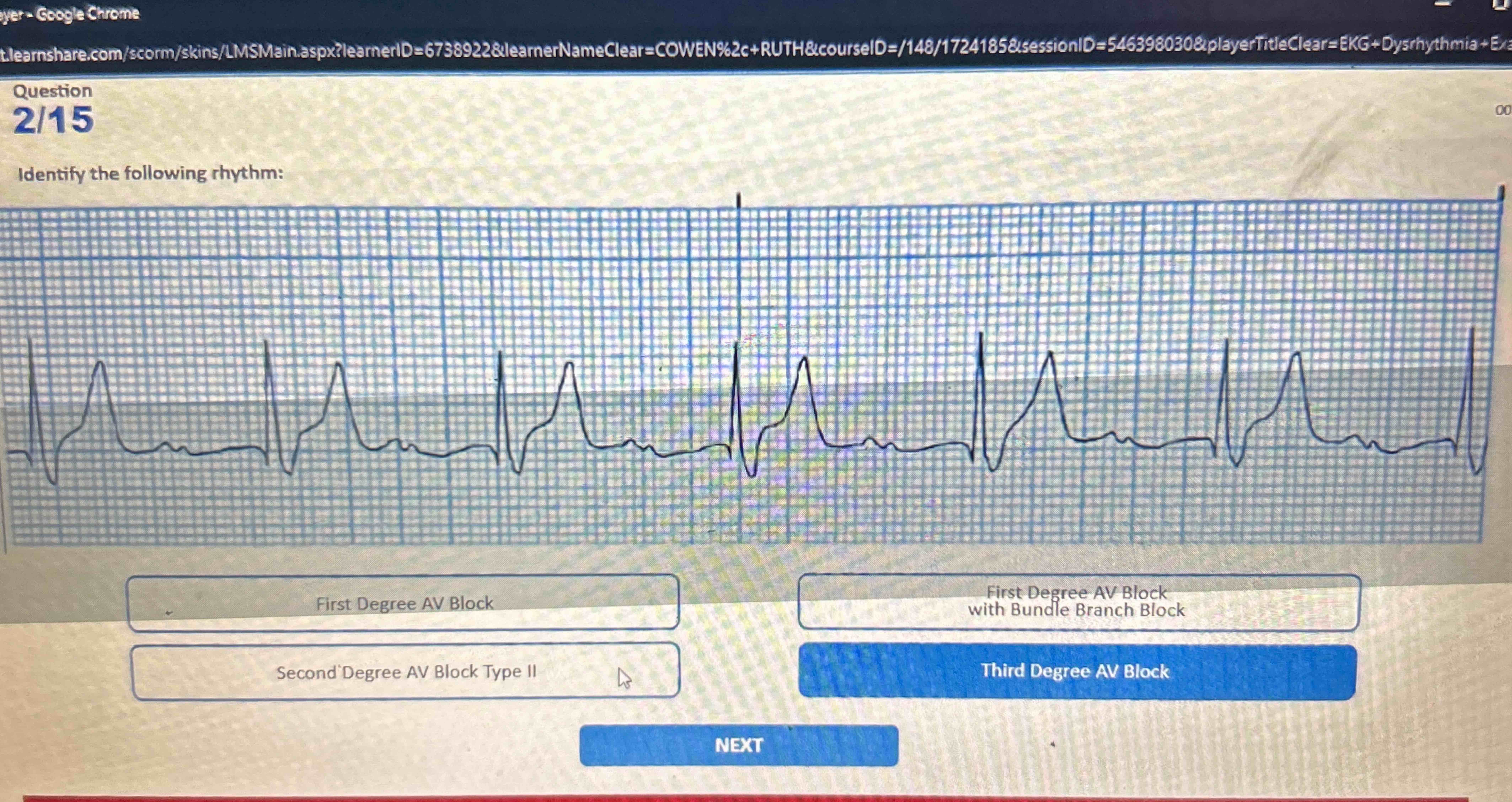 Solved Identify the following rhythm: First Degree AV Block | Chegg.com