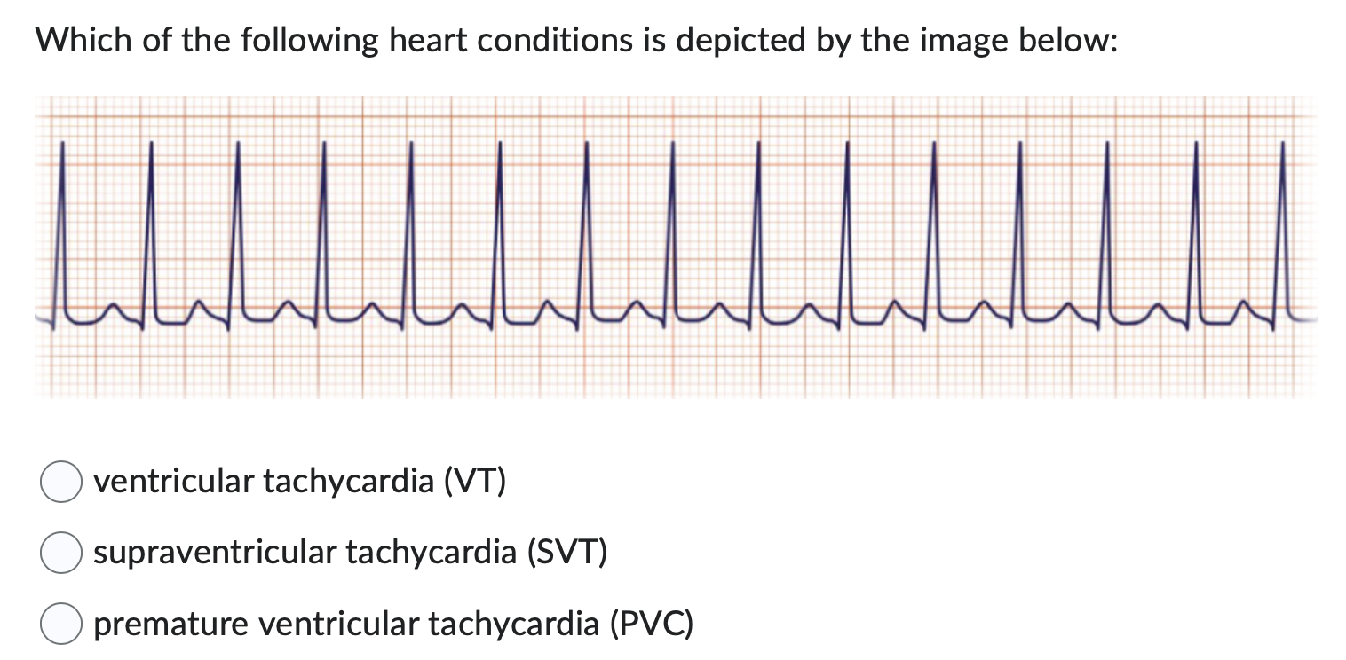 Solved Which of the following heart conditions is depicted | Chegg.com